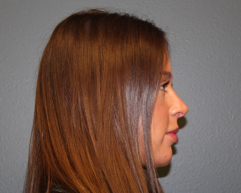 Nose Surgery | Plastic Surgery Associates of South Dakota